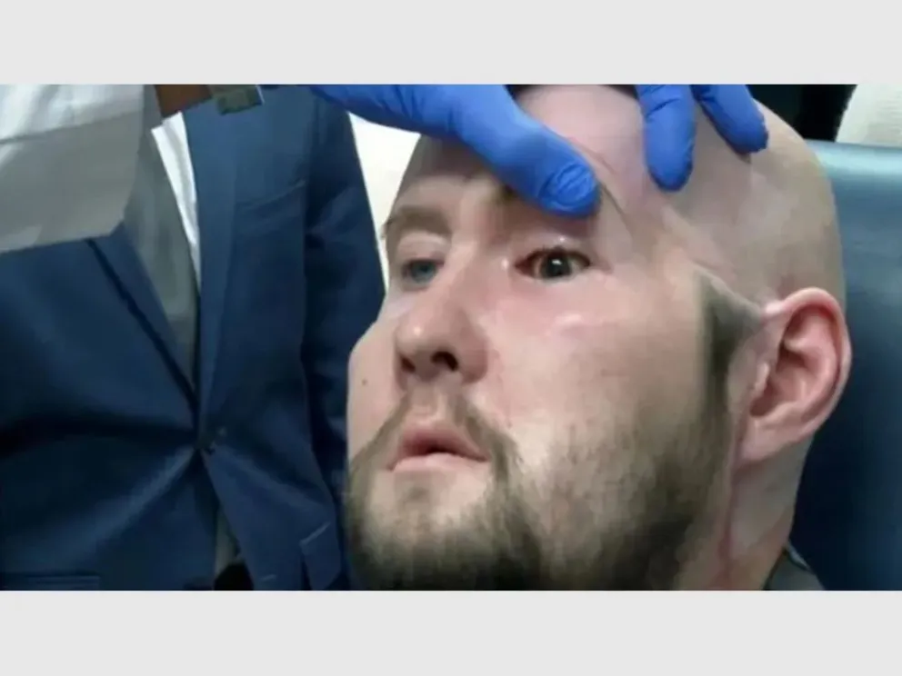 Realizaron con éxito el primer trasplante de ojo del mundo | NoticiasNQN
